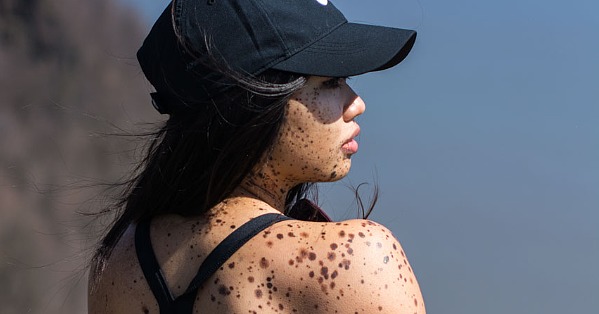Living With a Skin Condition | POPSUGAR Beauty