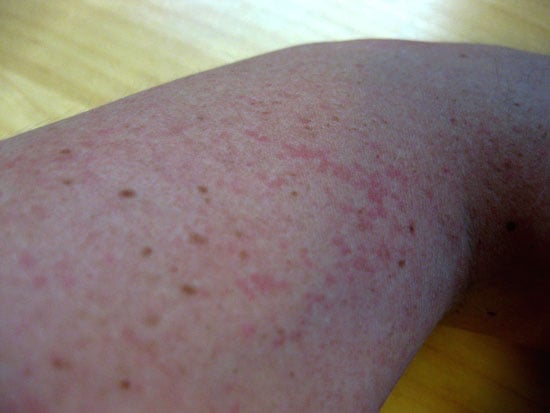 Garden Rash | POPSUGAR Fitness