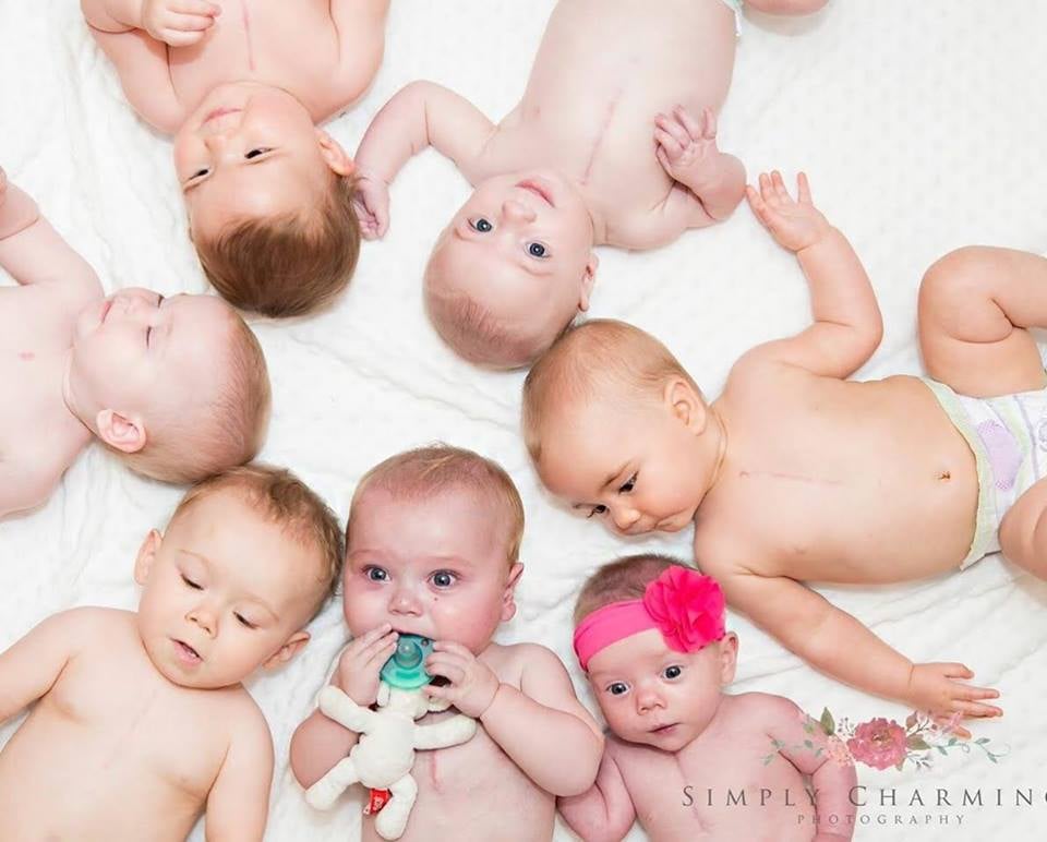 Photo of Babies With Chest Scars From Open-Heart Surgeries | POPSUGAR ...